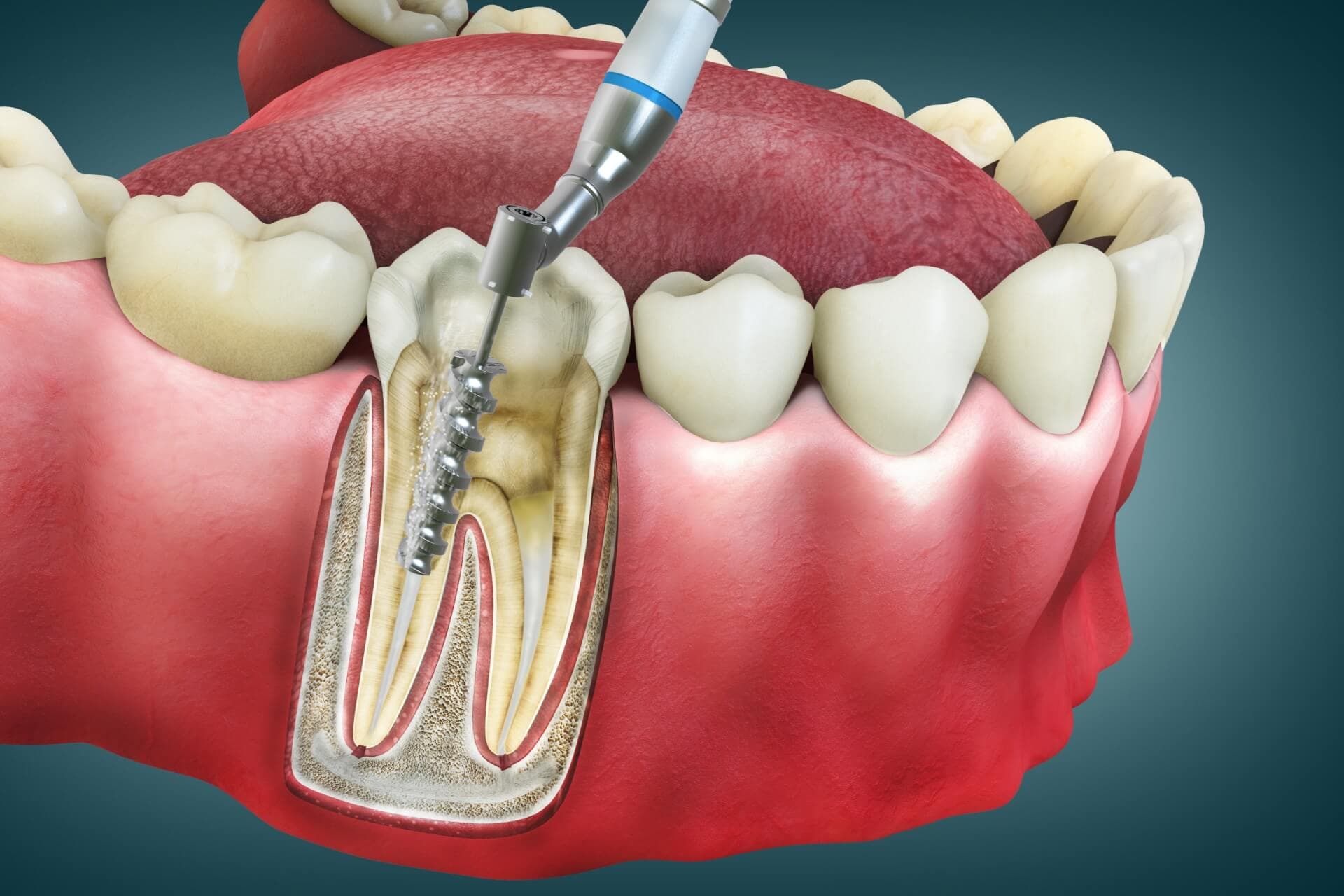A Complete Guide to Root Canal Treatment: Procedure, Benefits, and Cost