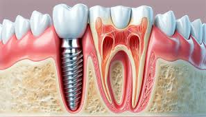 Understanding Dental Implants: Benefits, Procedure, and Cost